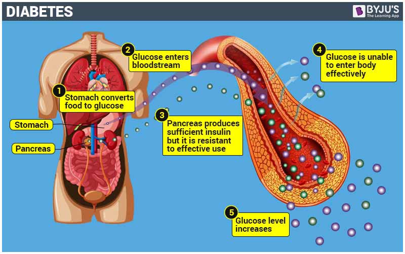 Diabetes Mellitus What You Need To Know Fajar Magazine Diabetes Mellitus What You Need To Know Fajar Magazine