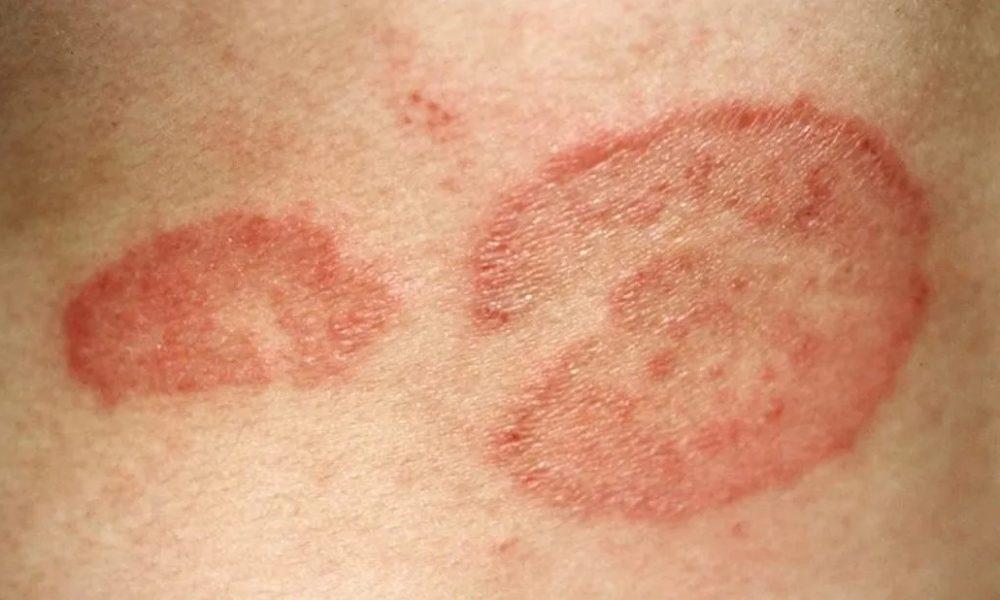 Ringworm: Symptoms, Causes, and Treatment - Fajar Magazine